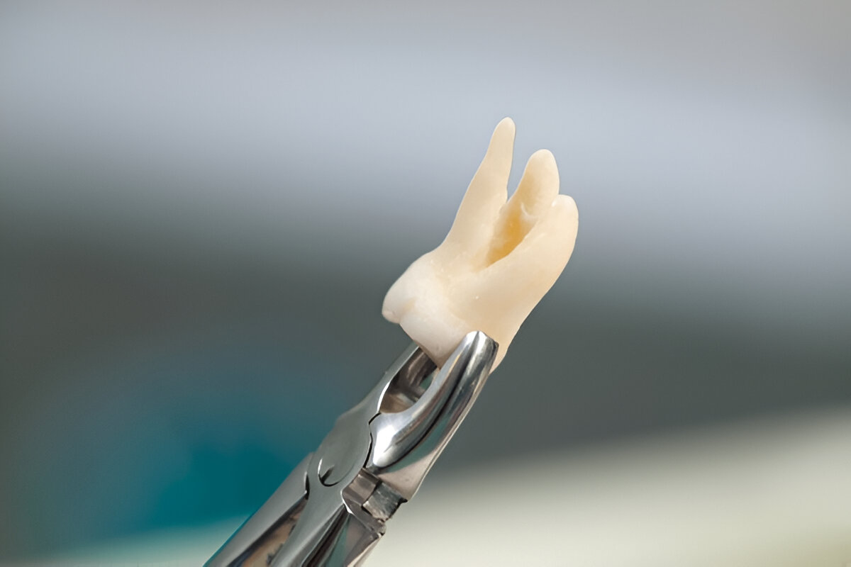 Teeth Extraction & Minor Surgeries | Les Dents Clinic